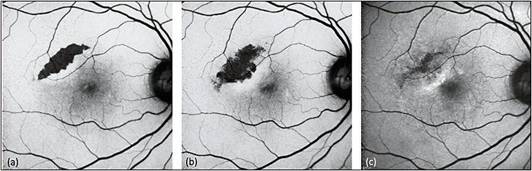 Retinal Physician | PentaVision