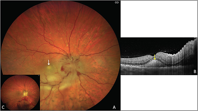 Retinal Physician | PentaVision