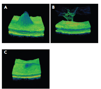 Retinal Physician | PentaVision