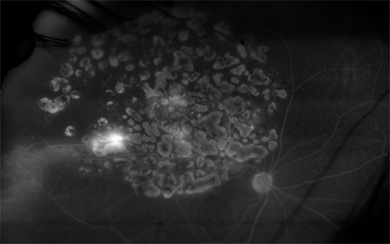 Retinal Physician | PentaVision