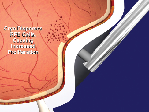 Retinal Physician | PentaVision