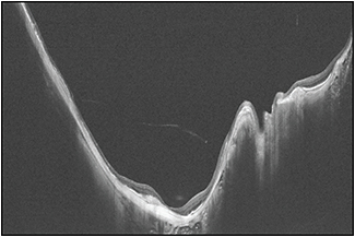 Retinal Physician | PentaVision