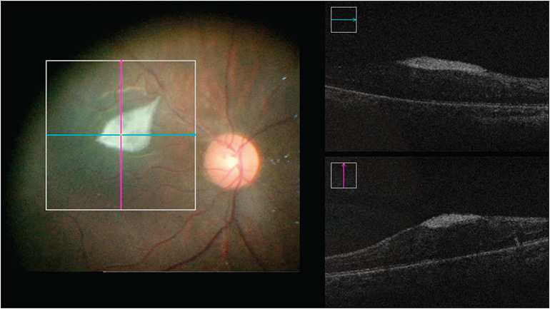 Retinal Physician | PentaVision