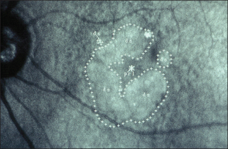 Retinal Physician | PentaVision