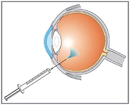 Retinal Physician | PentaVision