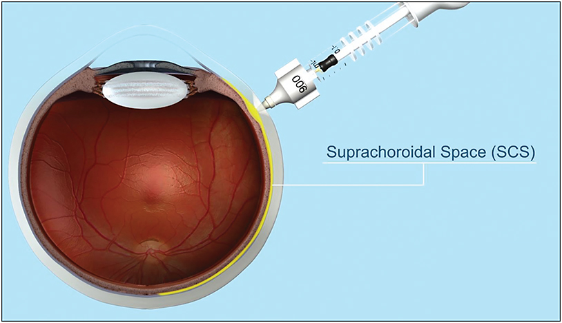 Retinal Physician | PentaVision