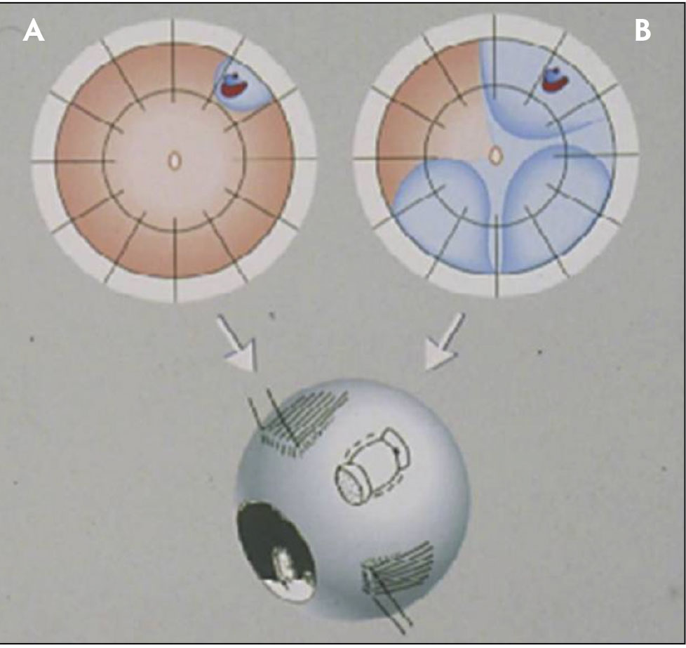 Scleral Buckling for Phakic Rhegmatogenous Retinal Detachment | Retinal ...