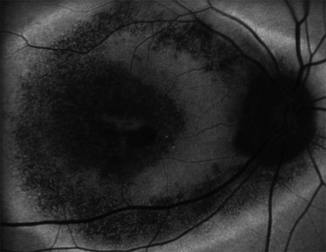 Retinal Physician | PentaVision