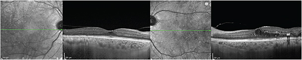 Retinal Physician | PentaVision