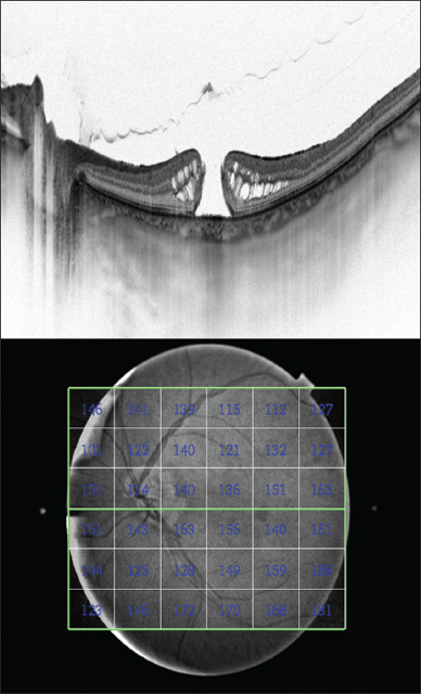 Retinal Physician | PentaVision