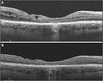 Retinal Physician | PentaVision