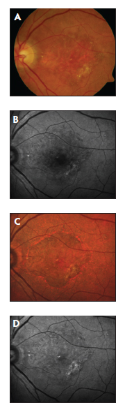 Retinal Physician | PentaVision
