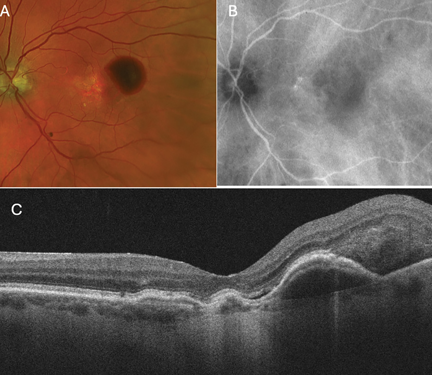 Diagnosing and Managing Polypoidal Choroidal Vasculopathy | Retinal ...