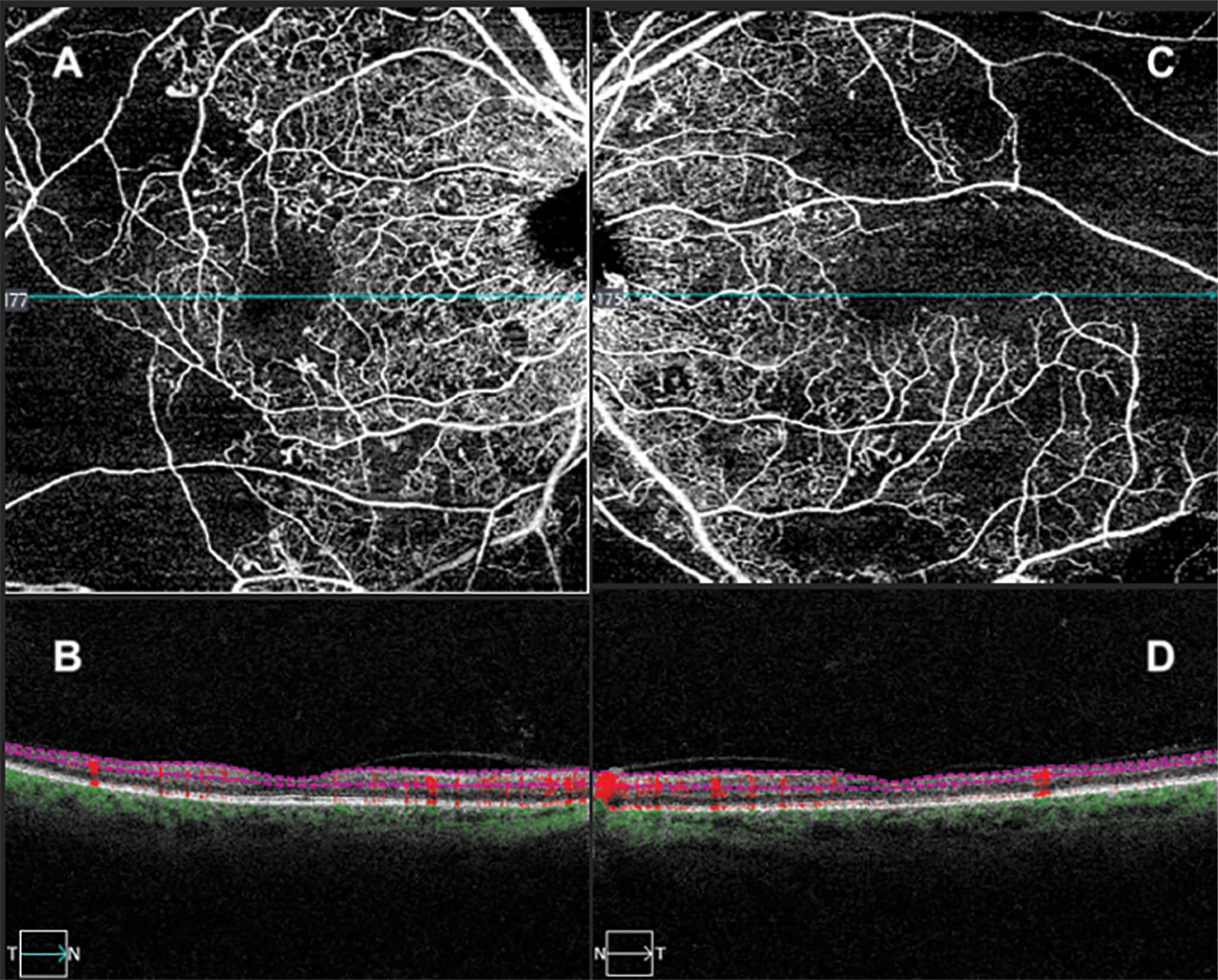 OCTA in the Retina Clinic | Retinal Physician