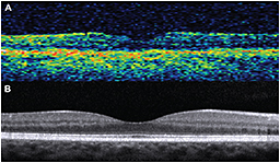 Retinal Physician | PentaVision