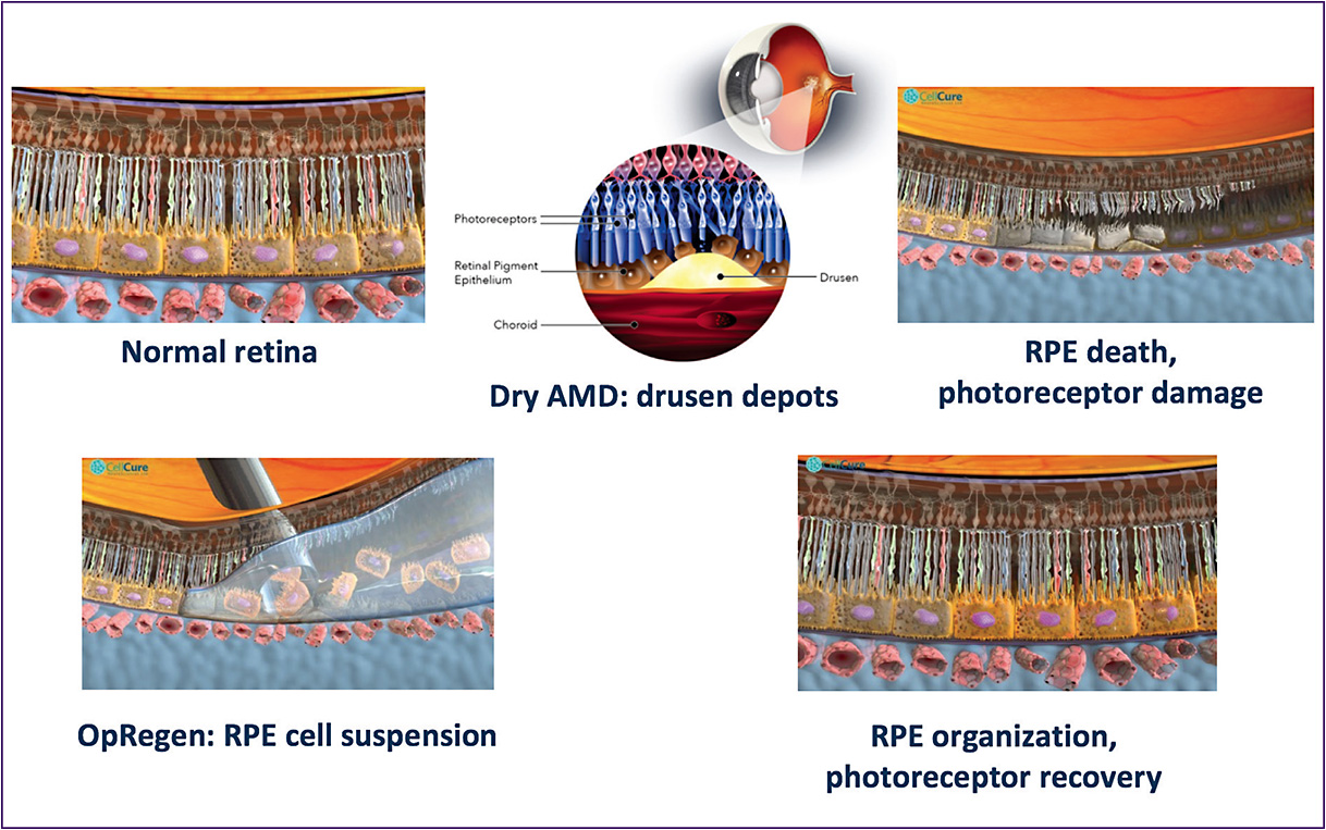 Retinal Physician | PentaVision