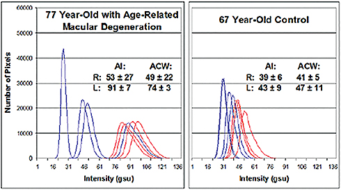 Retinal Physician | PentaVision