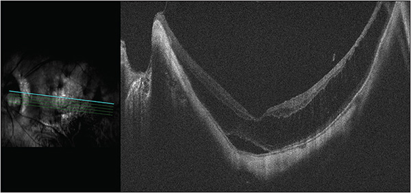 Retinal Physician | PentaVision