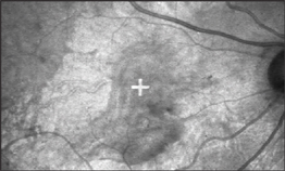 Retinal Physician | PentaVision