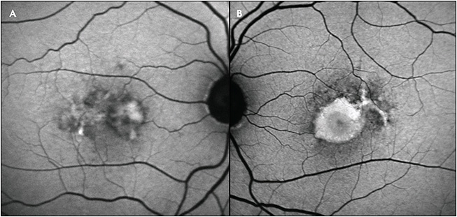 Retinal Physician | PentaVision