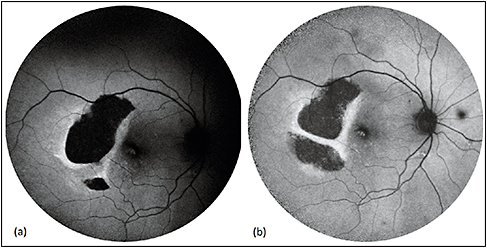 Retinal Physician | PentaVision