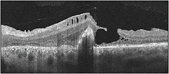 Retinal Physician | PentaVision