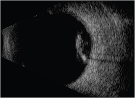 Retinal Physician | PentaVision