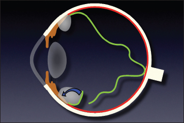 Retinal Physician | PentaVision