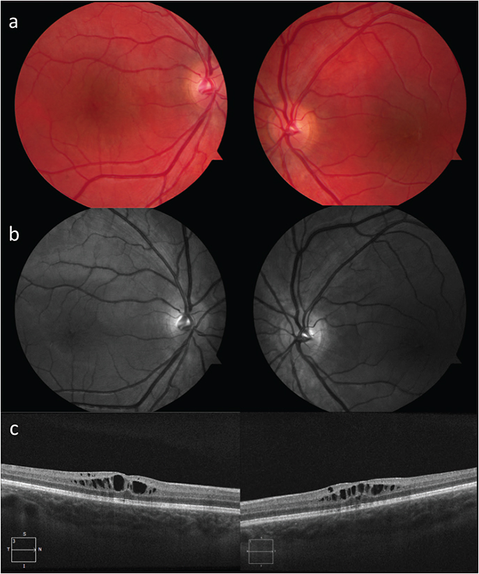 Retinal Physician | PentaVision