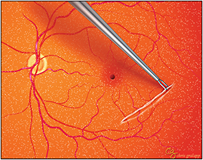 Retinal Physician | PentaVision