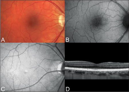 Retinal Physician | PentaVision