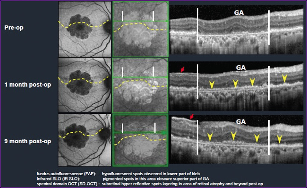 Retinal Physician | PentaVision