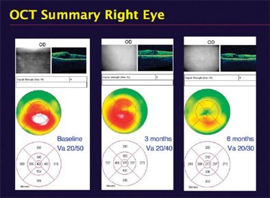 Retinal Physician | PentaVision