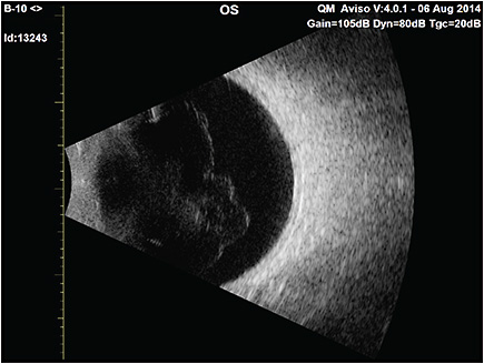 Retinal Physician | PentaVision