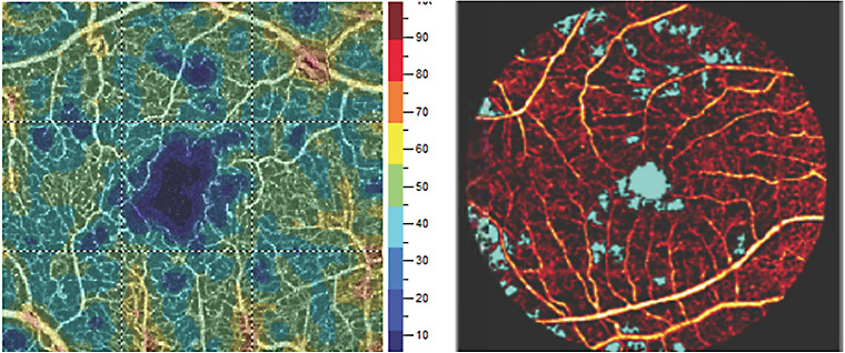 Retinal Physician | PentaVision