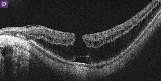 Retinal Physician | PentaVision