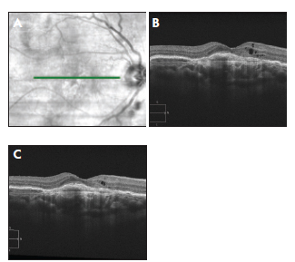 Retinal Physician | PentaVision