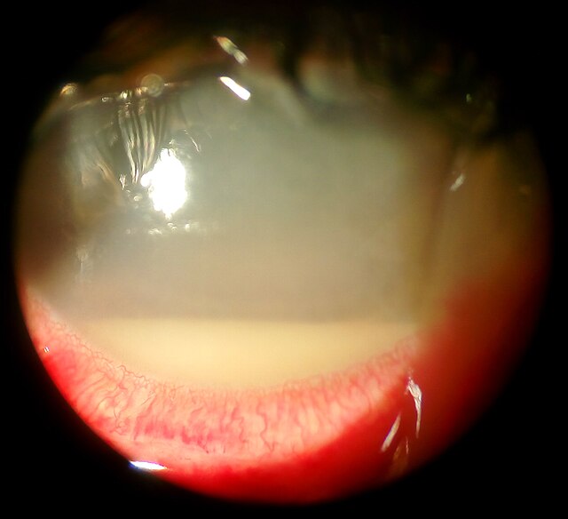 Exploring Risk of Endophthalmitis With Intravitreal Injections ...