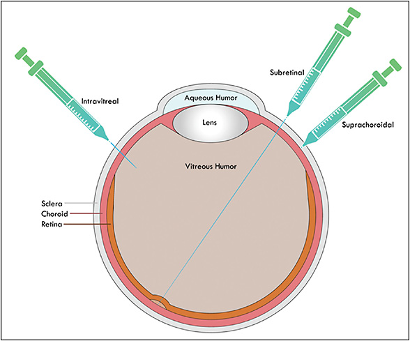 Retinal Physician | PentaVision