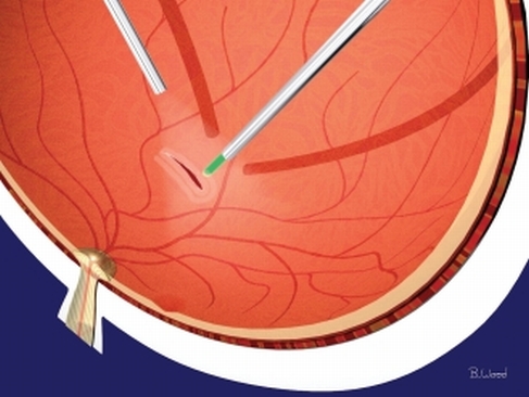 Retinal Physician | PentaVision