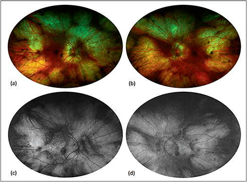 Retinal Physician | PentaVision