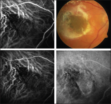 Retinal Physician | PentaVision