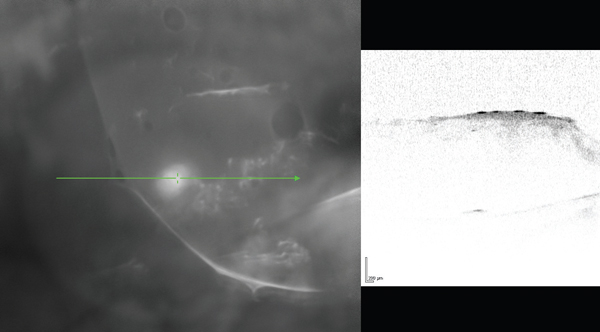 Retinal Physician | PentaVision