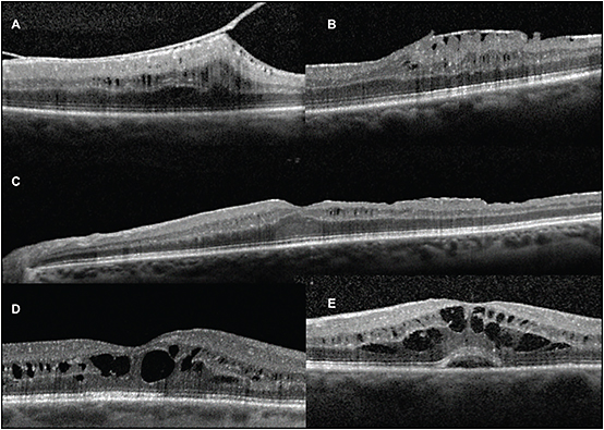 Retinal Physician | PentaVision