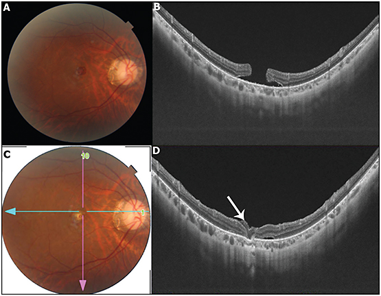Retinal Physician | PentaVision