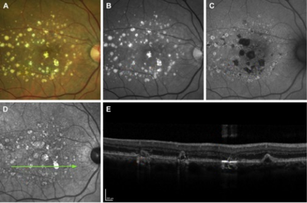 The Role of Multimodal Imaging in Geographic Atrophy Diagnosis and ...