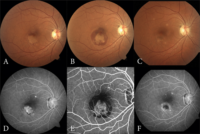 Retinal Physician | PentaVision