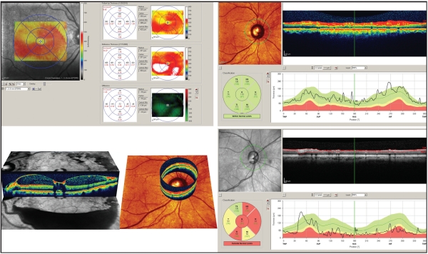 Retinal Physician | PentaVision