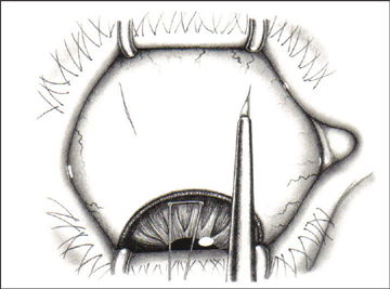 Retinal Physician | PentaVision