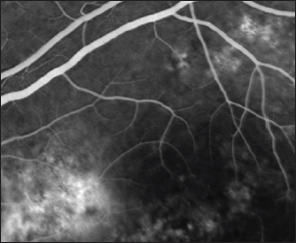 Retinal Physician | PentaVision